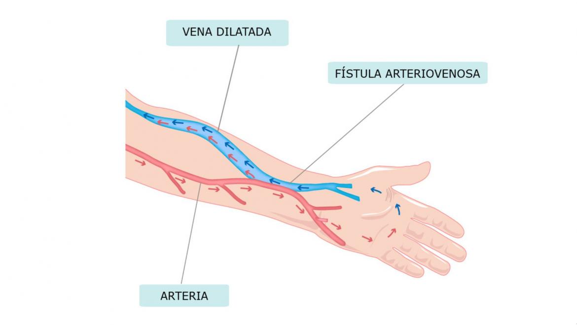 Fístula Arteriovenosa Qué Saber Hospital De Bellvitge